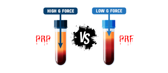 PRP vs. PRF: Which One is Right for Me? | Refine By Tulsi Med Spa