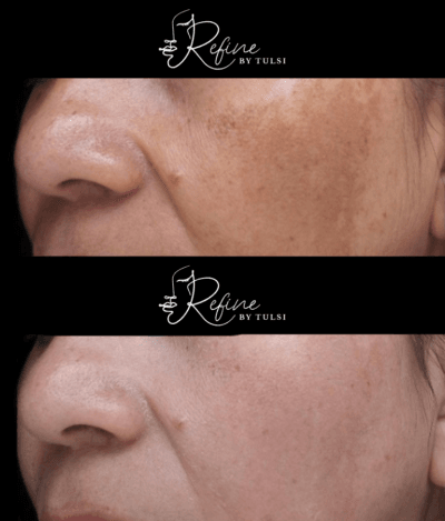 Patient 10 Laser Melasma Treatment Before and After