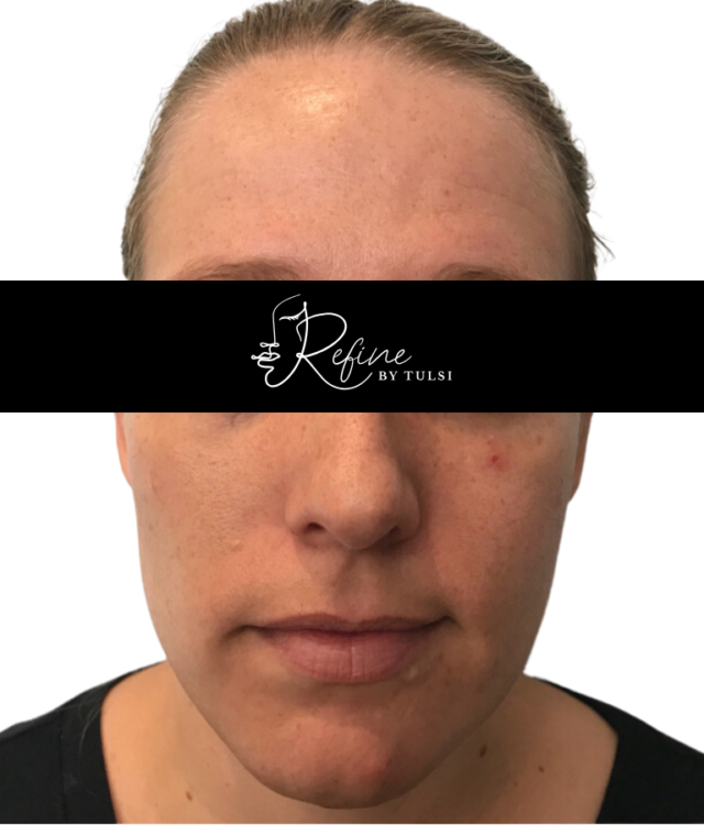 Patient 15 Facial Balancing with Fillers Before and After