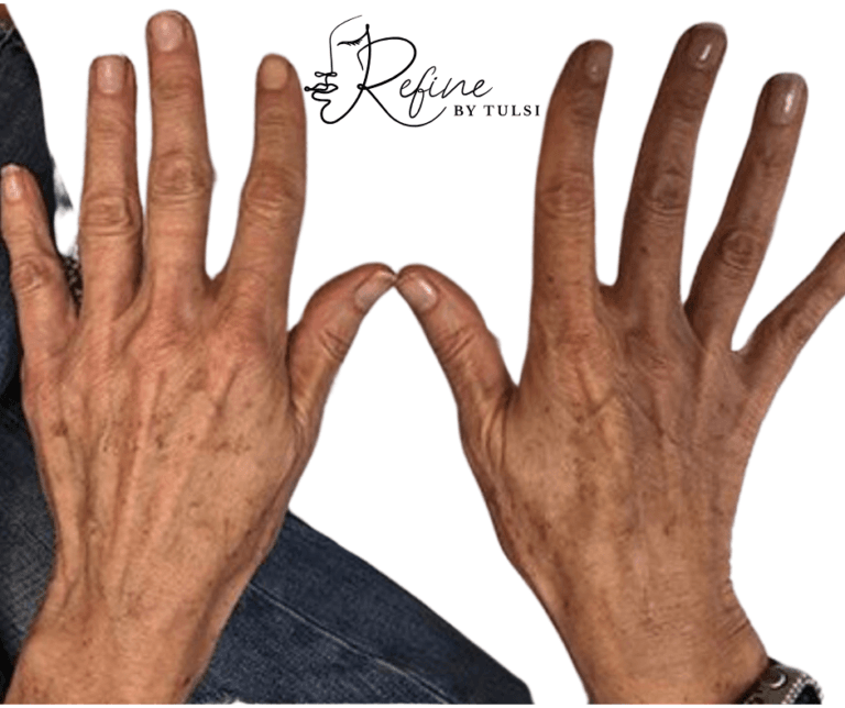 Patient 26 Hand Rejuvenation Before and After