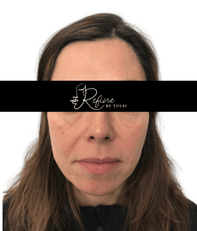 Patient 47 Facial Filler for Nasolabial folds and Cheeks Before and After